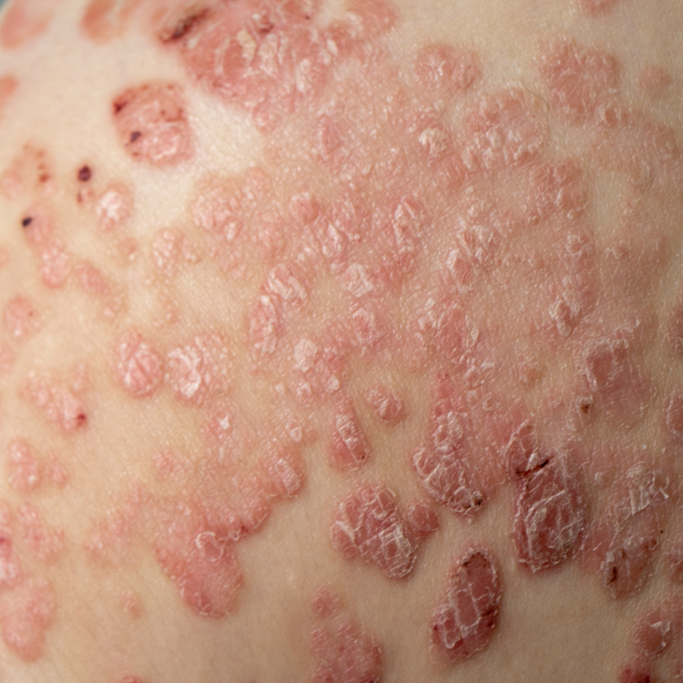 Psoriasis skin – Self
